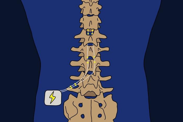 Brain scan predicts effectiveness of spinal cord surgery - Kowatek ...