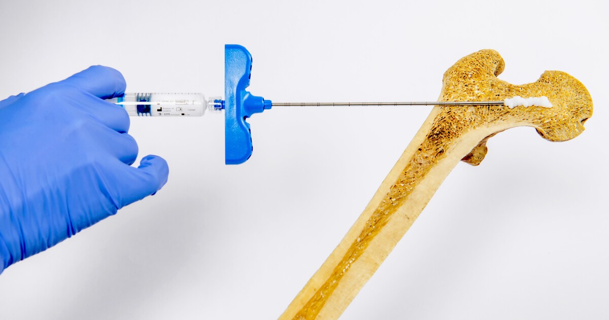 “Injectable bone” gel may be a radically better treatment for ...